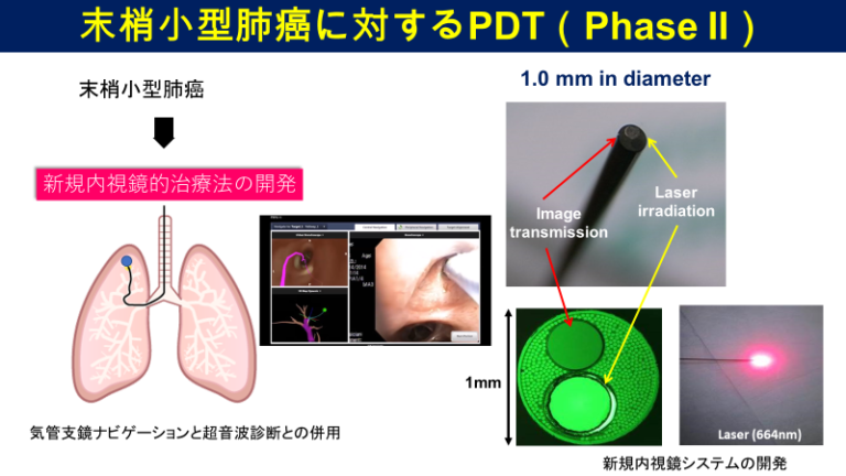 肺癌のPDT | 日本光線力学学会（JPA）