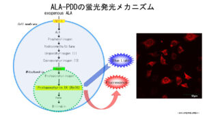 膀胱癌のPDD | 日本光線力学学会（JPA）